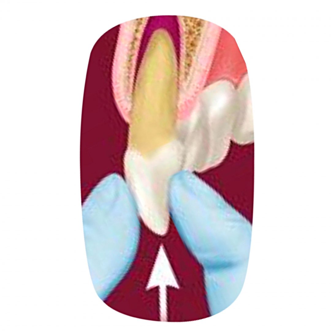 Salva un diente tras un golpe. ¿Sabes qué es la avulsión dental?
