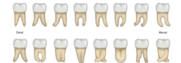 Extraer las muelas del juicio sin dolor - González y Casado