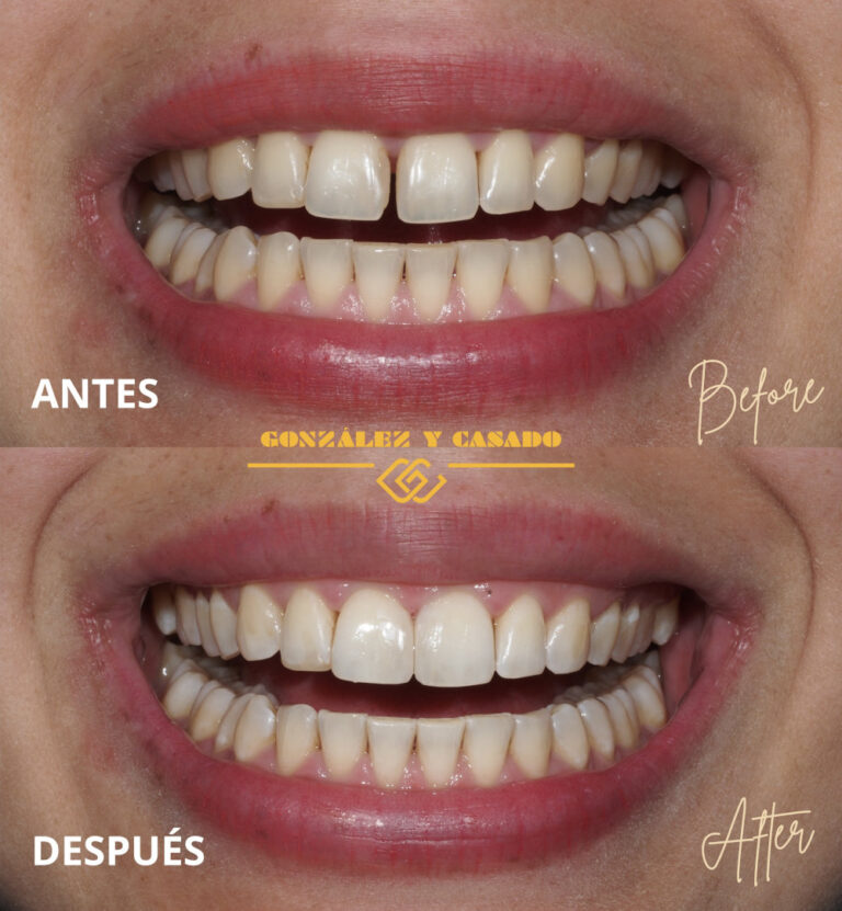 Cierre de diastema con reconstrucción de composite