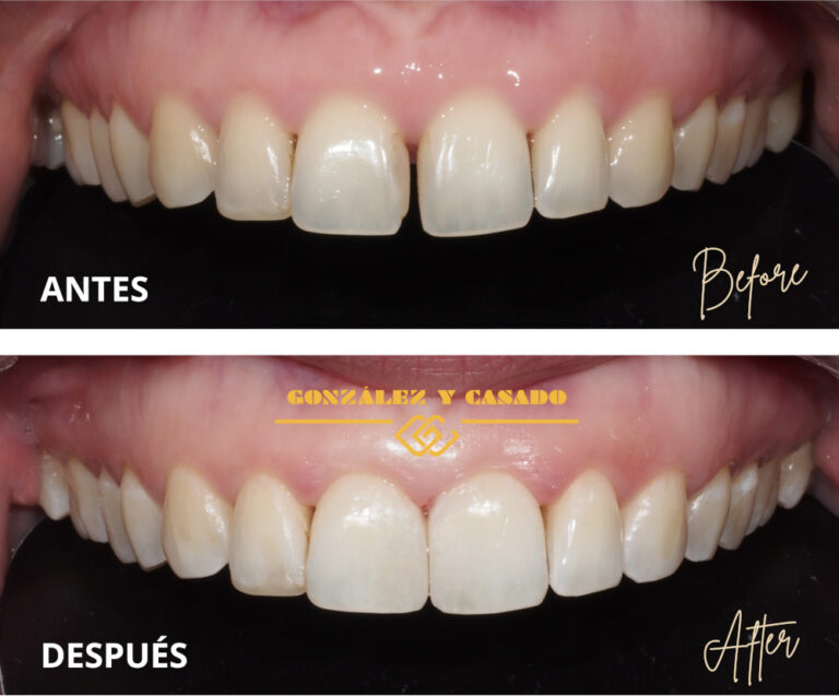 Cierre de diastema con reconstrucción de composite