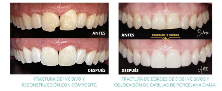 Muela rota: ¿Qué debo hacer y cuándo acudir al dentista? - González y ...